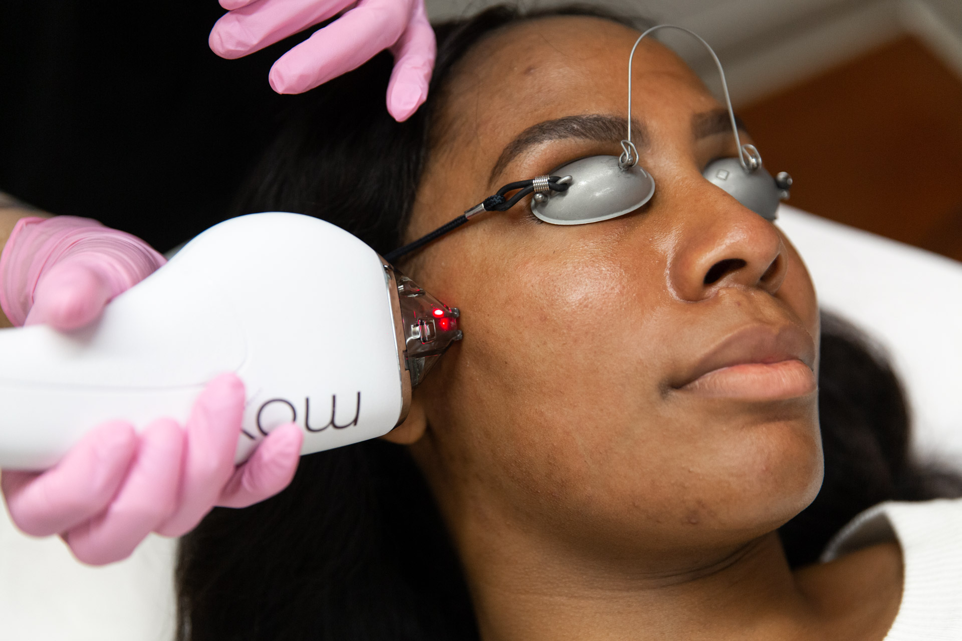 How Moxi Laser Works And Why You Should Consider It Skin