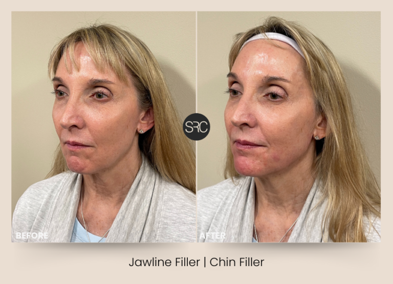 Jawline Filler Archives | Skin Rejuvenation Clinic Skin Rejuvenation Clinic