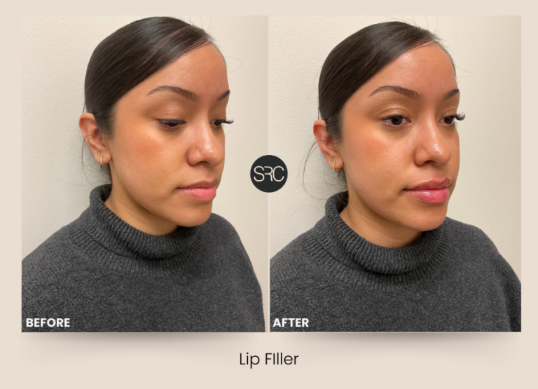 Sculptra - Skin Rejuvenation Clinic Skin Rejuvenation Clinic